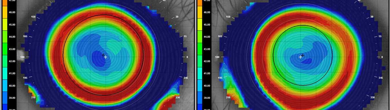 Ortho K Lenses For Adults & Children Singapore | OK Lens - Eyecare People